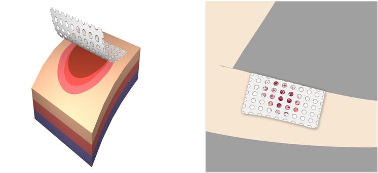 Silicone Net Wound Dressing
